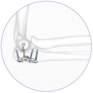 IJS® Elbow Stabilization System – Orthospec SA