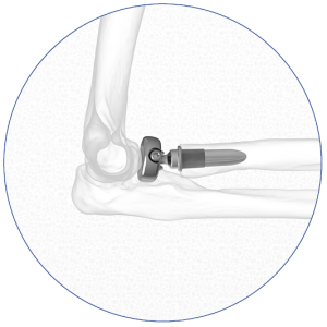 Align® Radial Head System – Orthospec SA