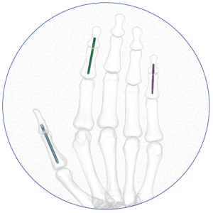 Reduct® Arthrodesis Screw System – Orthospec SA