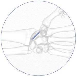Reduct® Headless Compression Screw System – Orthospec SA