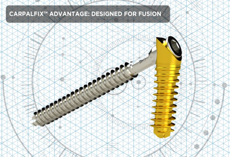 Carpalfix – Carpal fusion fixation system – Orthospec SA