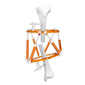 3D Computer-Assisted External Fixator – Orthospec SA