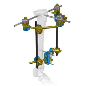 External Fixation Modular Rod System – Orthospec SA